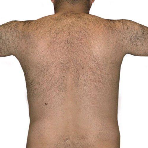 Laser Hair Removal Sun Prairie | Shine Med Spa